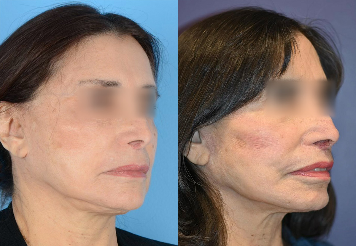 Patient 303817 | Lip Lift Before & After Photos | Hadlock Facial ...