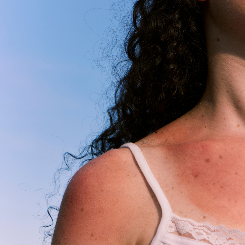 Best sunburn relief for your teen | luna app