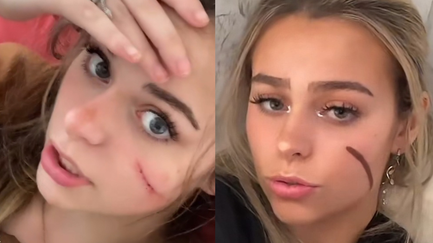TikToker "Scar Girl" Annie Is Accused Of Faking Her Scar By Drawing It ...