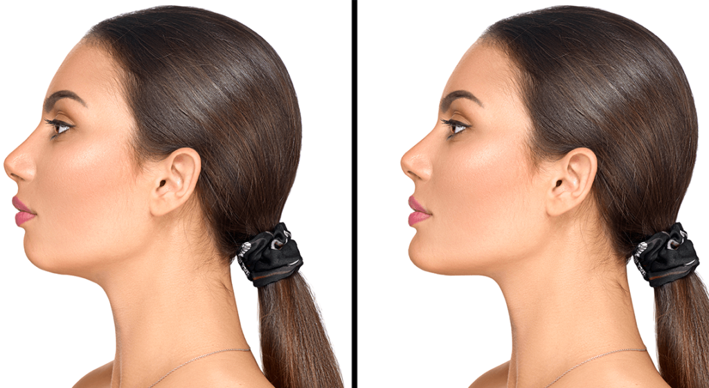 All You Need to Know About Chin Implants