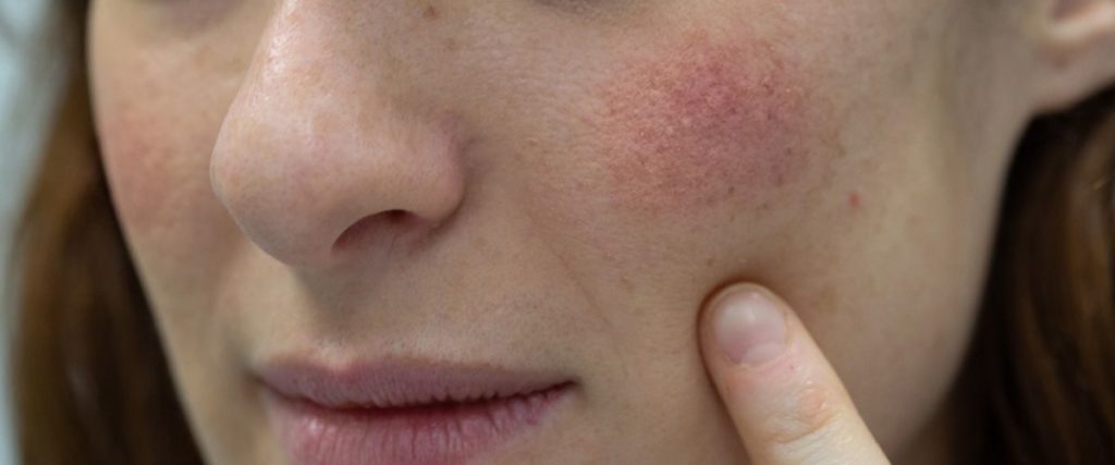 How Stress and Other Factors Cause Rosacea | Austin, TX