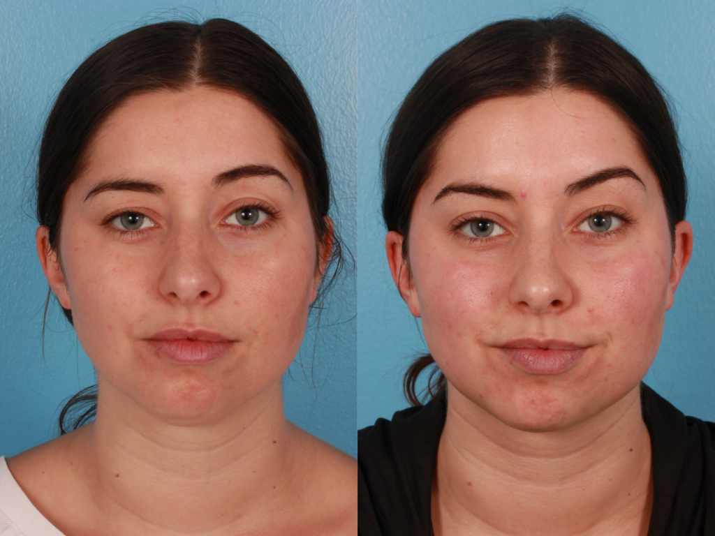 Neck Liposuction Austin | Submental Microliposuction in Austin, TX