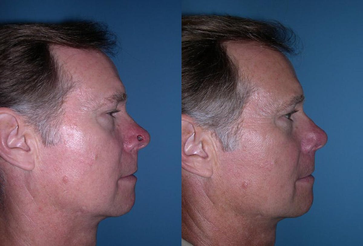 Patient 716863 | Skin Cancer Before & After Photos | Buckingham Center ...