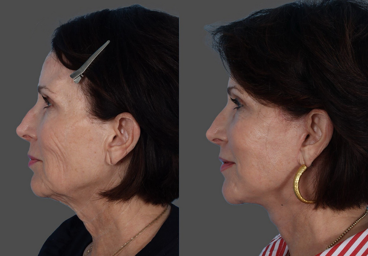 Patient 474062 | Facelift Before & After Photos | Buckingham Center for ...