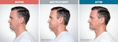 Kybella Before & After Photos | Gambhir Cosmetic Medicine