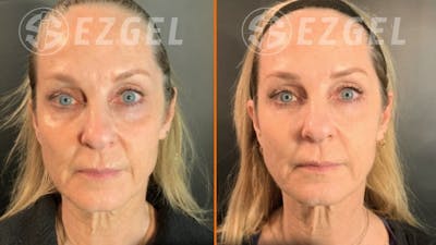 Gel Lift Before & After Photos | Gambhir Cosmetic Medicine