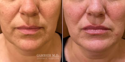 Skinvive Before & After Photos | Gambhir Cosmetic Medicine