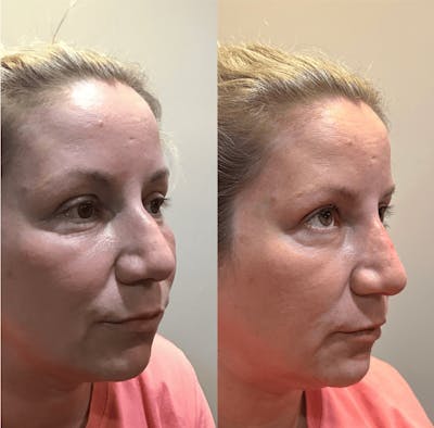 Liquid Rhinoplasty Before & After Photos | Gambhir Cosmetic Medicine