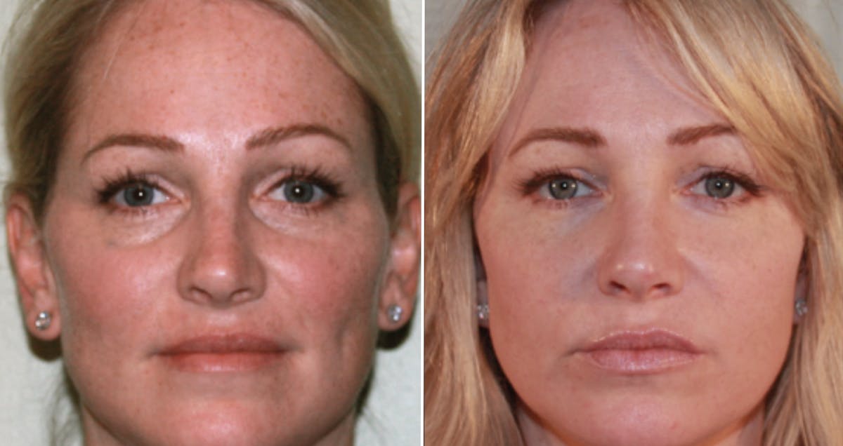 PRP & PRF | Gambhir Cosmetic Medicine