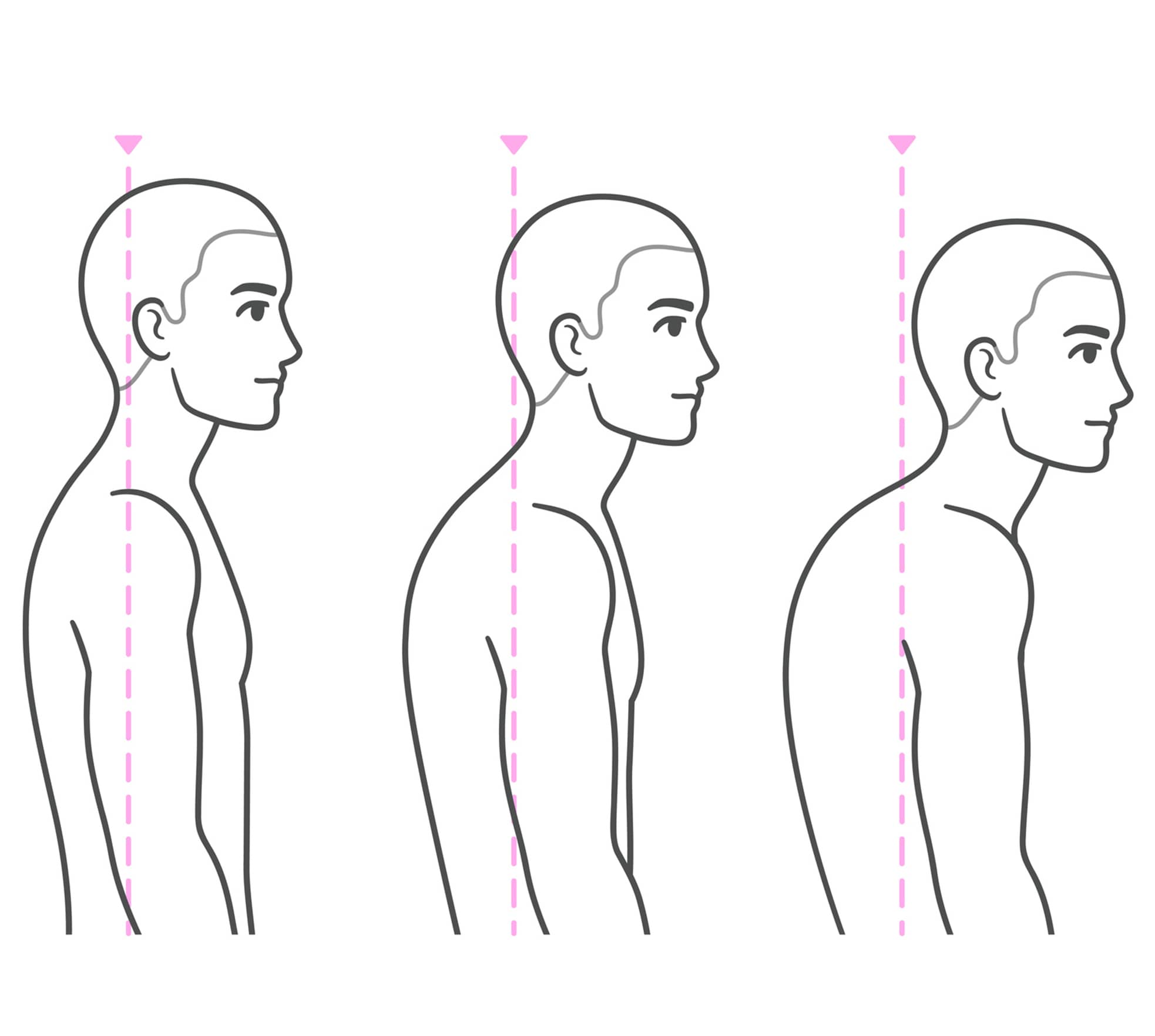 Kyphosis - Shrewsbury, NJ & Toms River, NJ: Center for the Functional ...