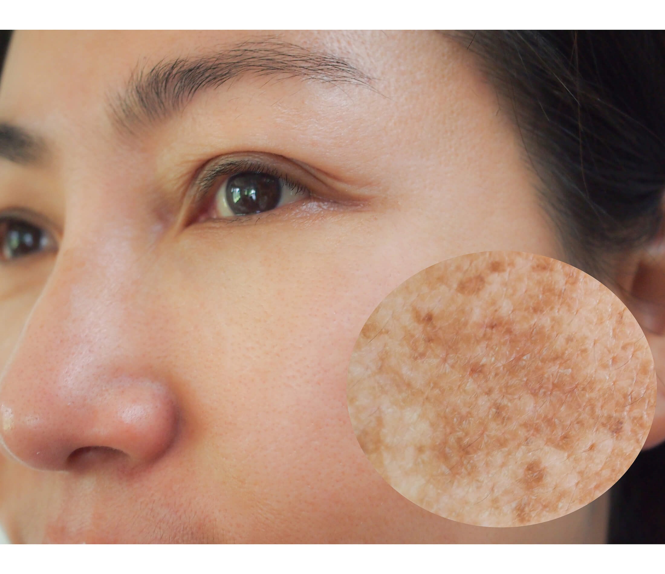 5 Ways to Prevent Dark Spots From Becoming Darker
