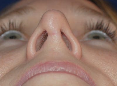 Septal Perforation Repair Before & After Photos | Klausner Institute