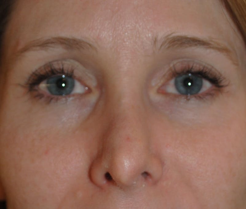 Patient 373153 | Septal Perforation Repair Before & After Photos ...