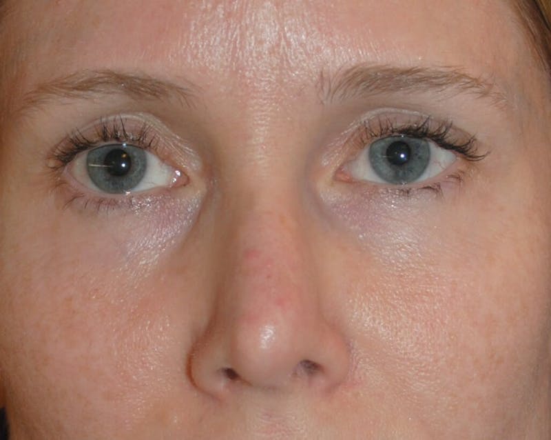 Patient 373153 | Septal Perforation Repair Before & After Photos ...