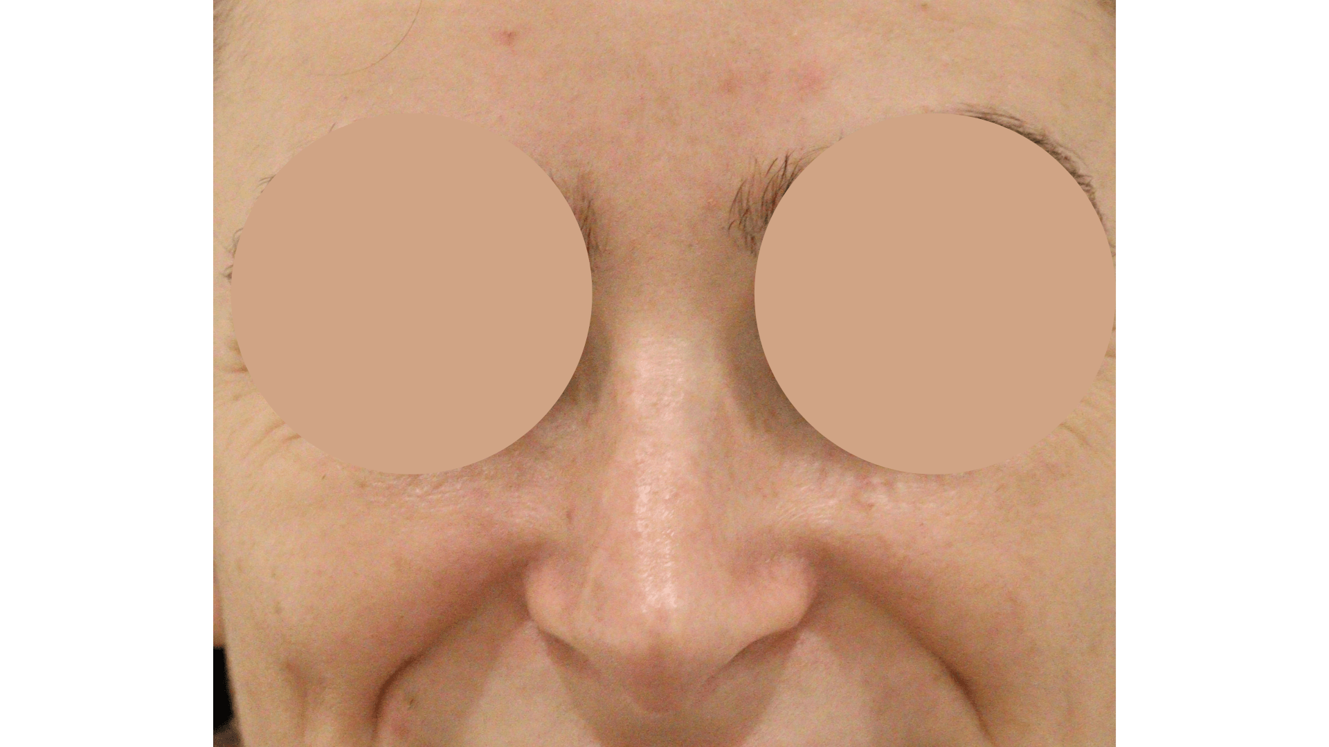 Patient 226475 | Septal Perforation Repair Before & After Photos ...