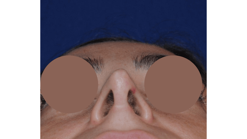 Patient 226475 | Septal Perforation Repair Before & After Photos ...