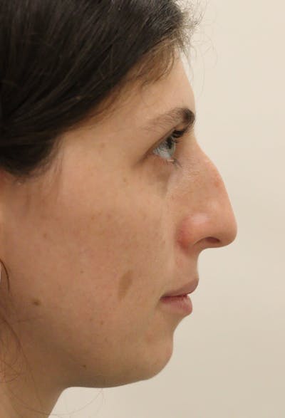 Nasal Valve Collapse Treatment Before & After Photos | Klausner Institute
