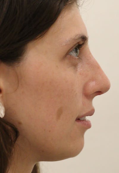 Nasal Valve Collapse Treatment Before & After Photos | Klausner Institute