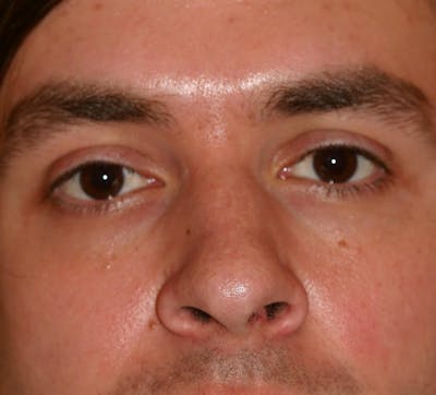 Nasal Valve Collapse Treatment Before & After Photos | Klausner Institute