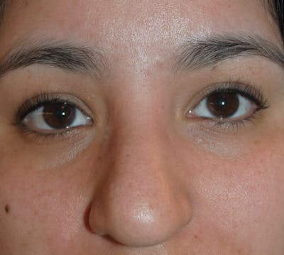 Nasal Valve Collapse Treatment Before & After Photos | Klausner Institute