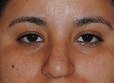 Nasal Valve Collapse Treatment Before & After Photos | Klausner Institute