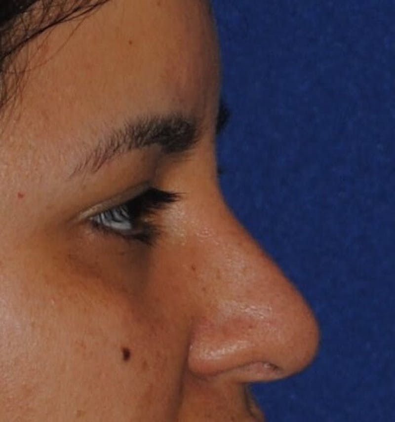 Patient 200263 | Nasal Valve Collapse Treatment Before & After Photos ...