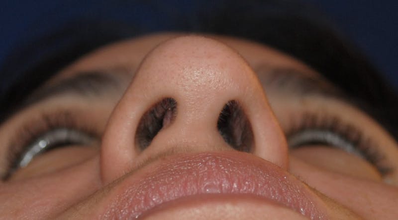 Patient 200263 | Nasal Valve Collapse Treatment Before & After Photos ...