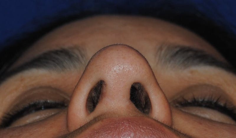 Patient 200263 | Nasal Valve Collapse Treatment Before & After Photos ...