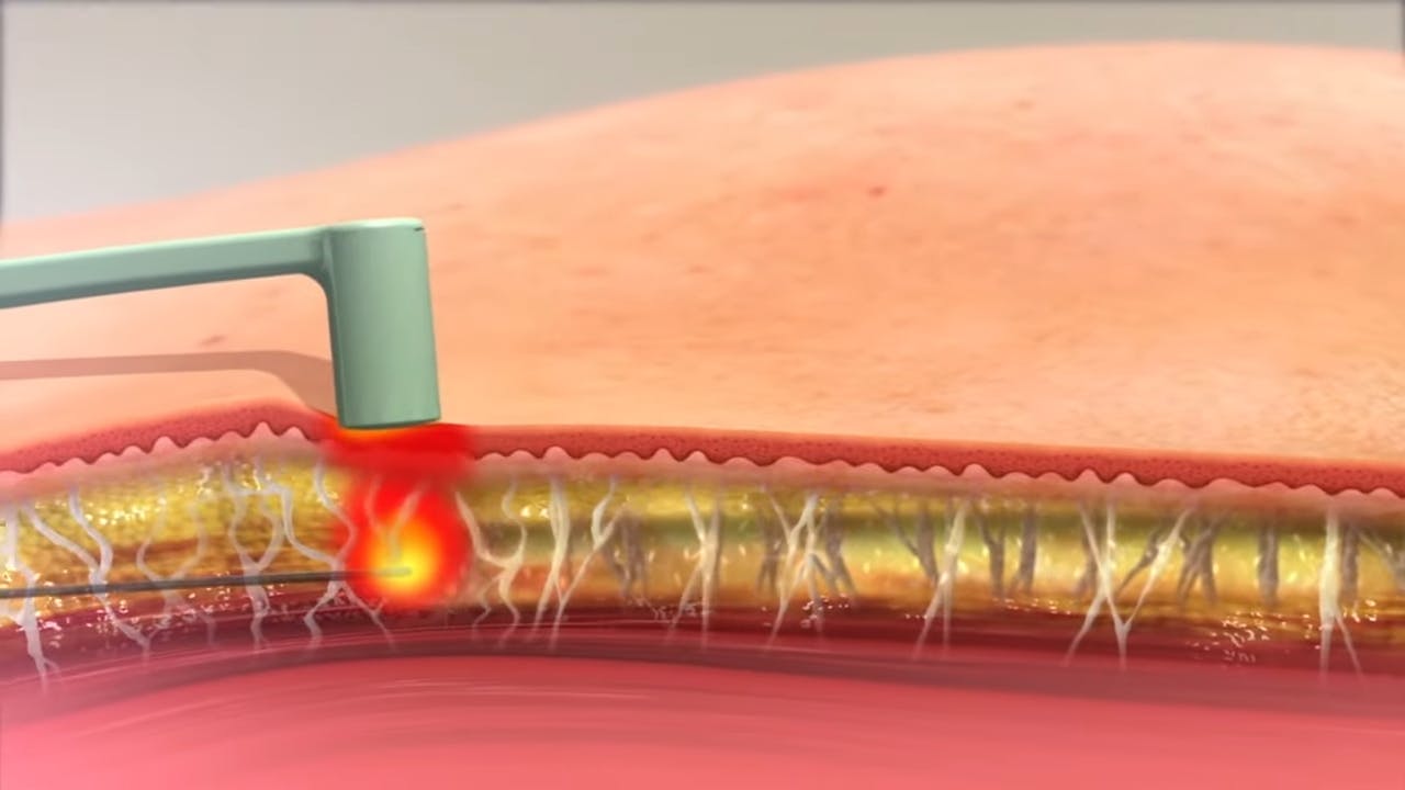 FaceTite in New York, NY | Lee Ann M. Klausner, M.D.