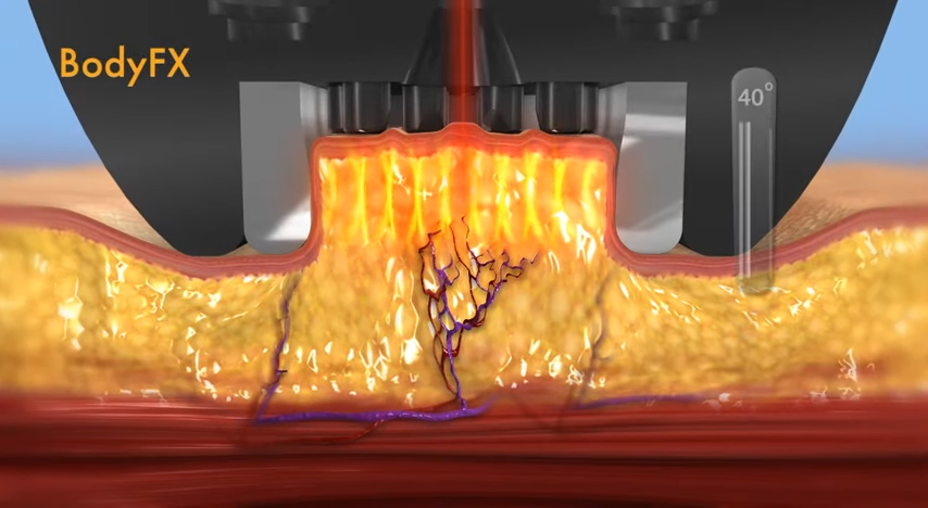 BodyFX in New York, NY | Lee Ann M. Klausner, M.D.