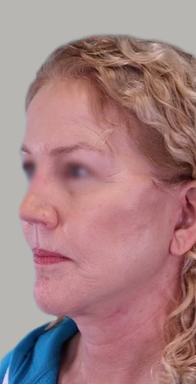 Neck Lift Before And After Photos Bay Hills By Dr Prem Tripathi