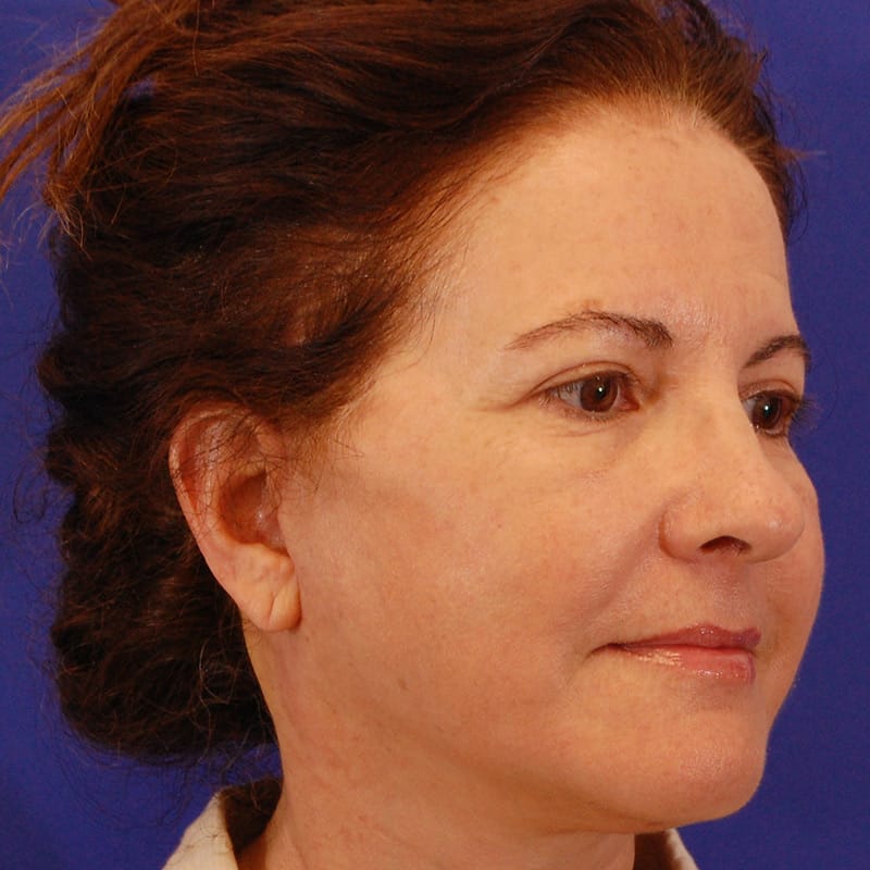 Patient 232659 | Facelift & Necklift Before & After Photos | Dr ...