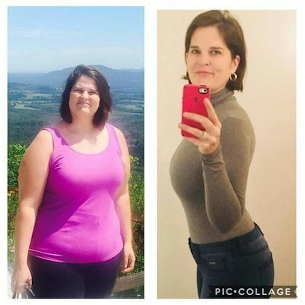 Patient 189951 Bariatric Surgery Before And After Photos Tijuana