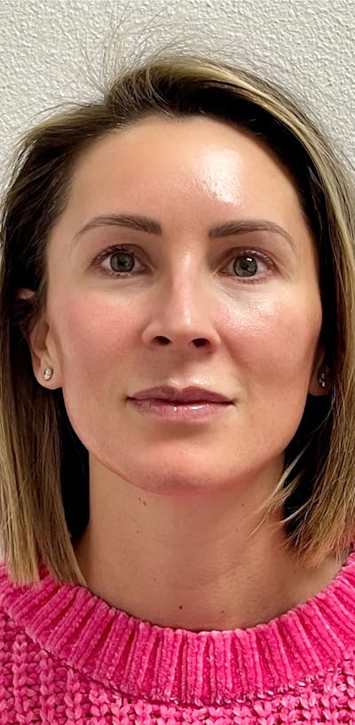 Sciton® Halo Before & After Photos | Setty Plastics & Aesthetics