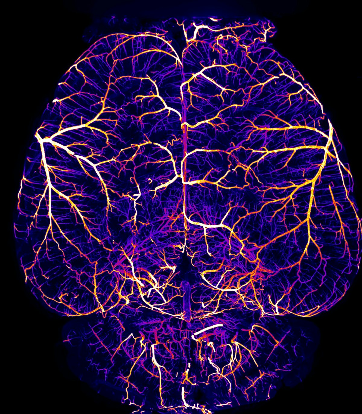 Leptomeningeal collaterals regulate reperfusion in ischemic stroke
