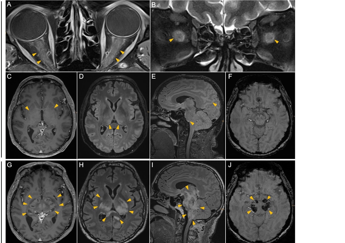 Acute haemorrhagic leucoencephalitis as clinical manifestation of MOG ...