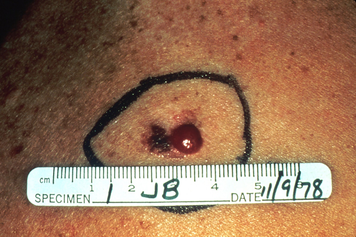 Understanding UV and skin cancer – timeline
