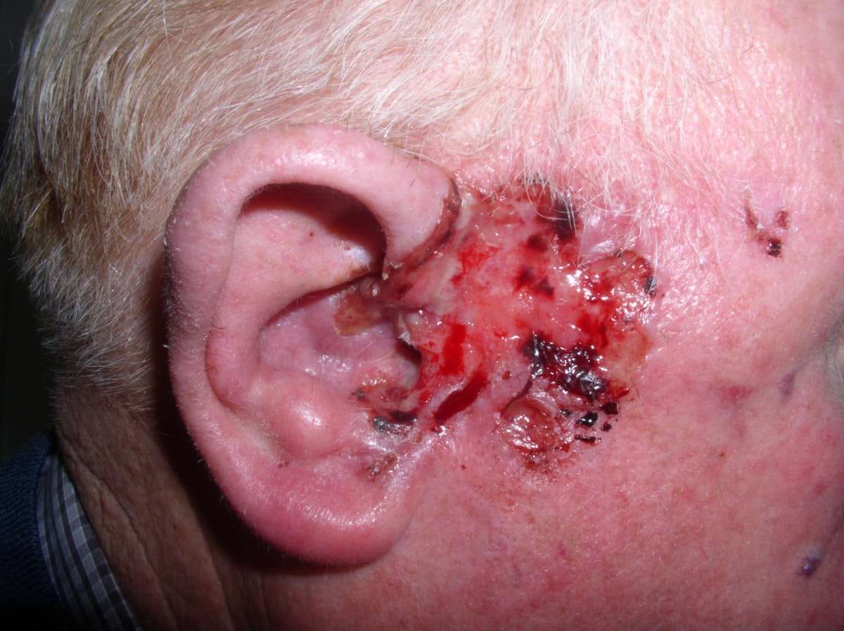 Basal cell carcinoma on face — Science Learning Hub