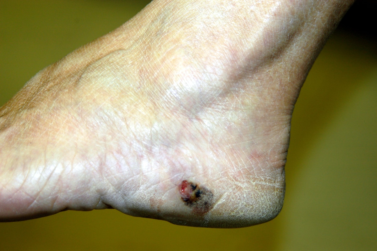 Melanoma on foot — Science Learning Hub