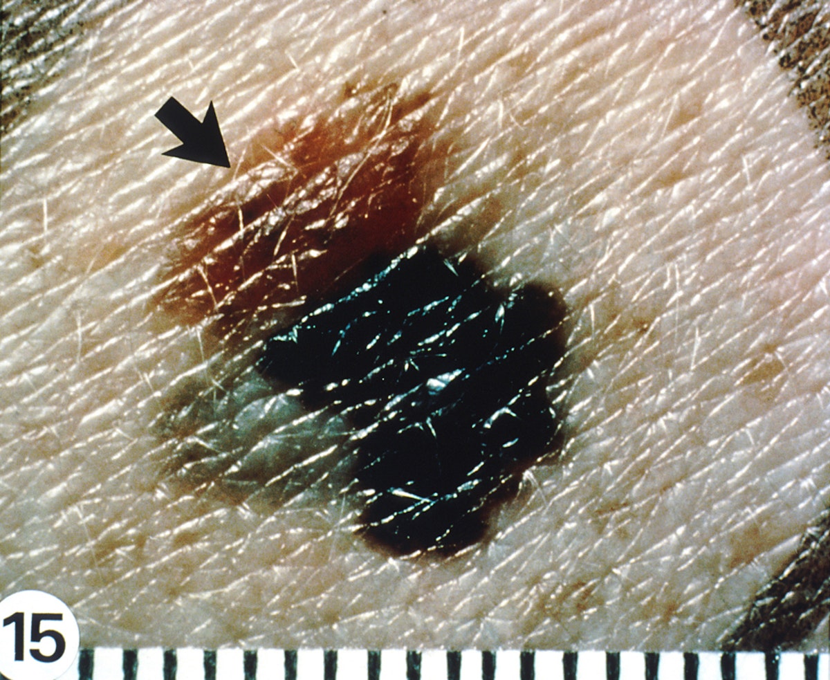 Skin cancer — Science Learning Hub
