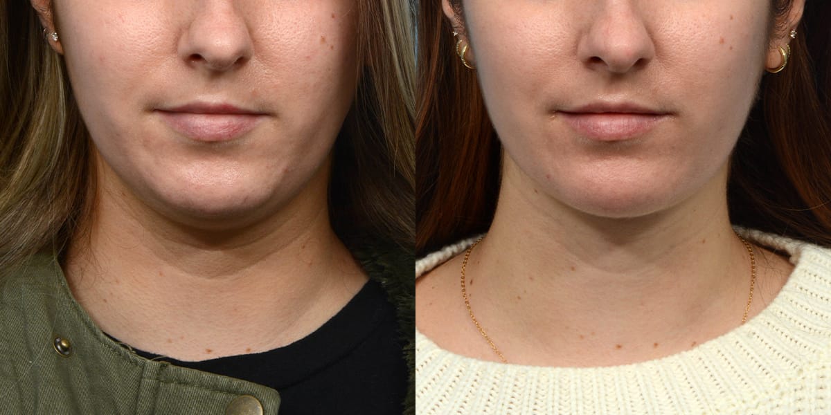 Patient 106642 | Submental Liposuction Before & After Photos | Dr. Wise