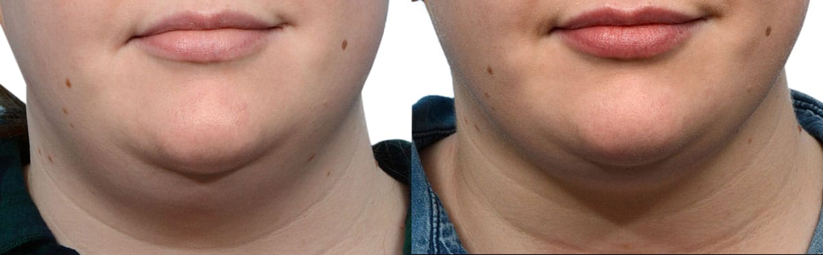 Patient 625304 | Submental Liposuction Before & After Photos | Dr. Wise