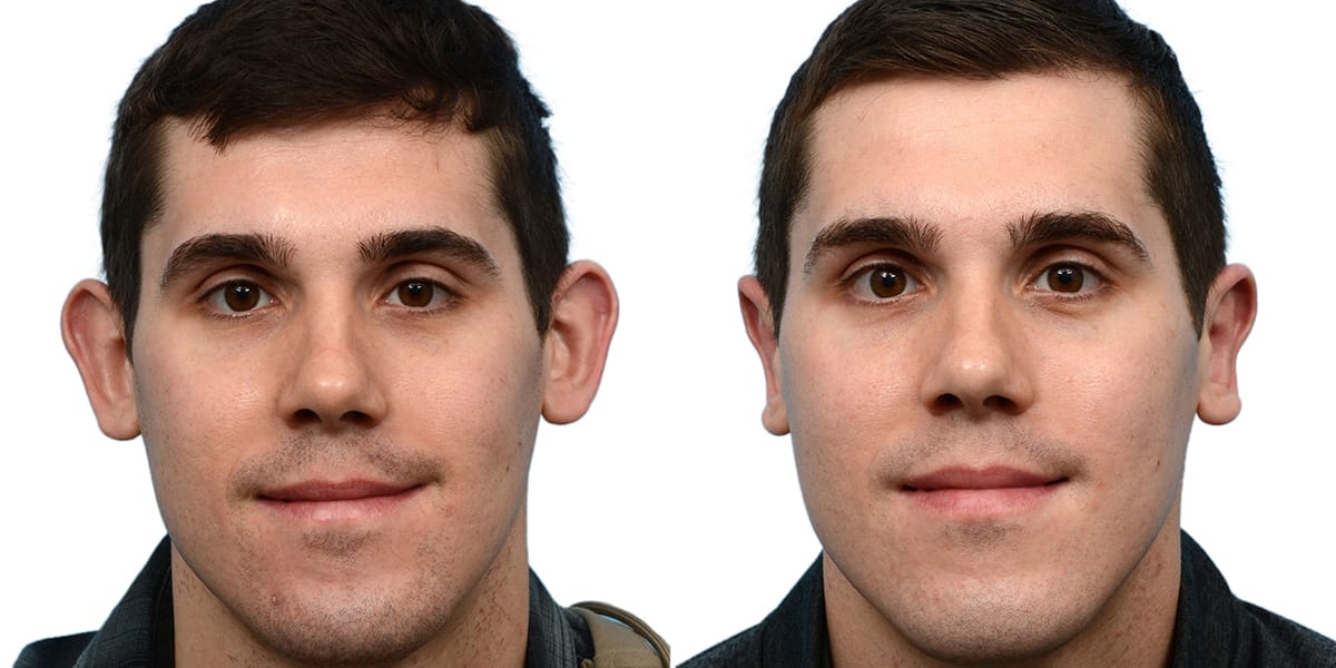 Patient 334262 | Otoplasty (Ear Surgery) Before & After Photos | Dr. Wise