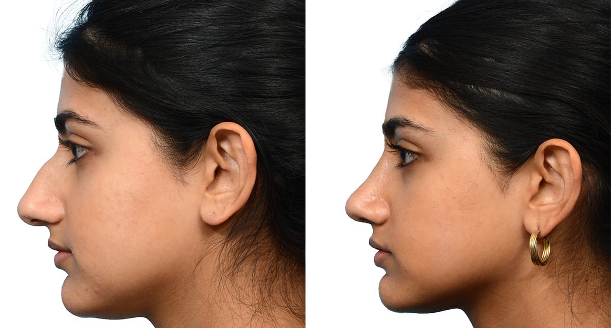 Patient 143915 | Rhinoplasty Before & After Photos | Dr. Wise