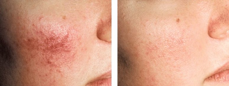 VBeam Perfecta - Wayne, NJ | Dr. Jeffrey Wise