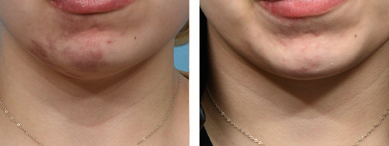 VBeam Perfecta - Wayne, NJ | Dr. Jeffrey Wise