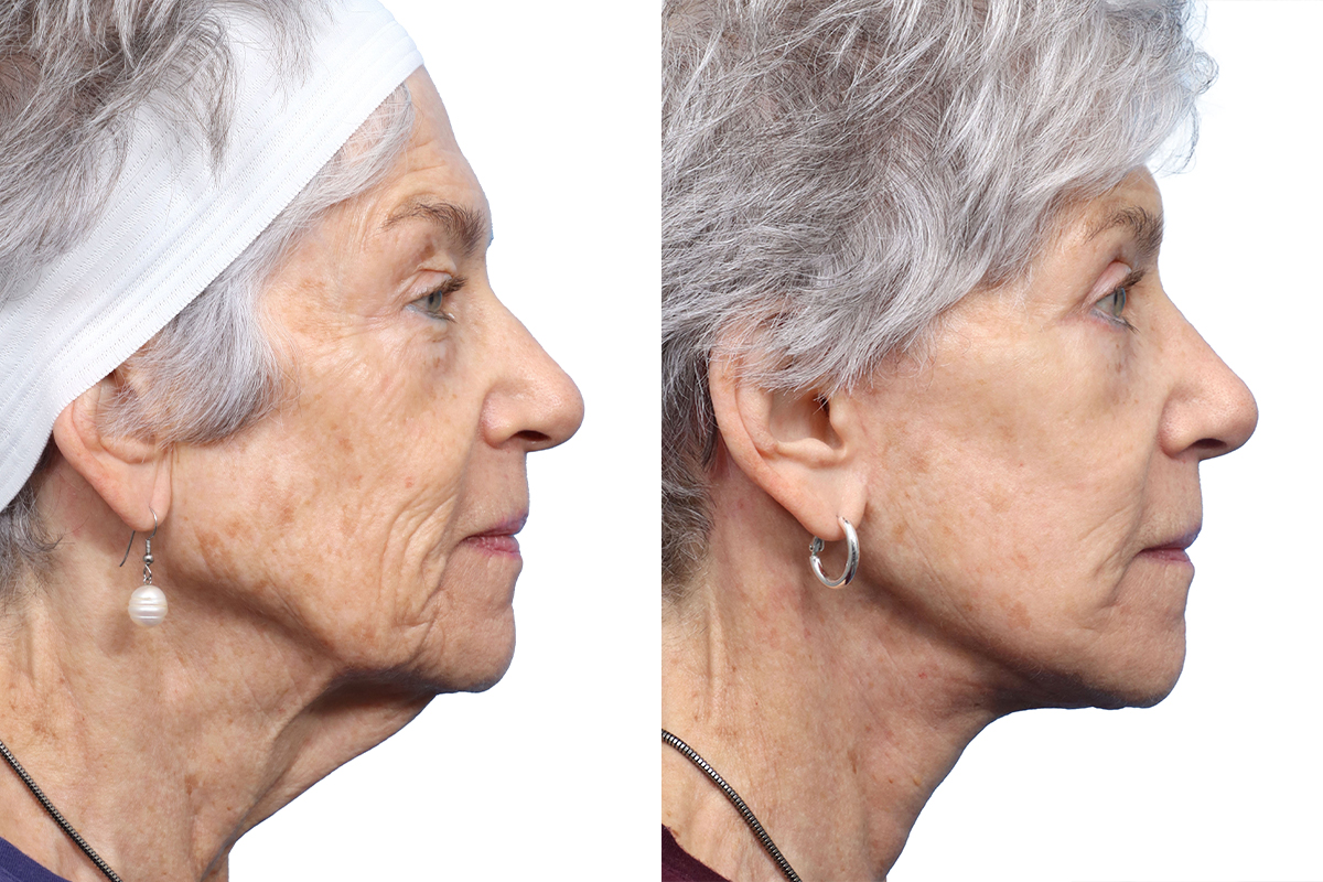 Patient 225528 | Facelift Before & After Photos | Dr. Wise