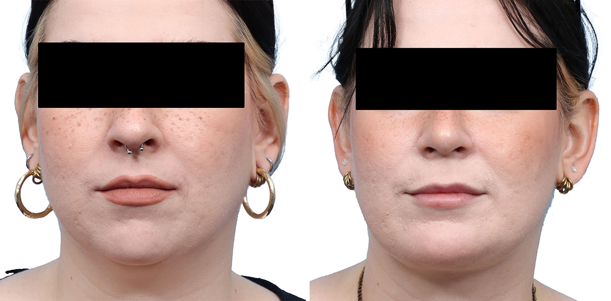 Patient 210177 | Submental Liposuction Before & After Photos | Dr. Wise