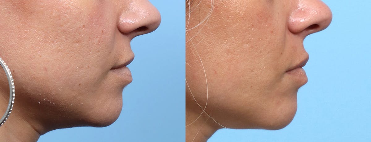 Patient 319577 | Skinpen Microneedling Before & After Photos | Dr. Wise