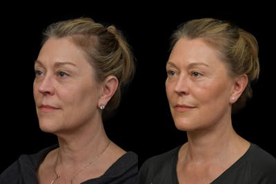 Changes Rapid Lift Before & After Photos | Changes Plastic Surgery